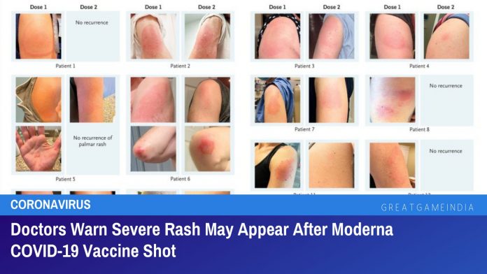 Doctors Warn Severe Rash May Appear After Moderna COVID-19 Vaccine Shot ...